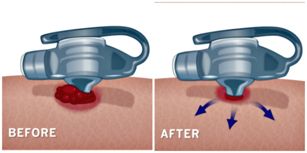 Treatment Packets - 2-Pack - Free US Shipping! – GranuLotion